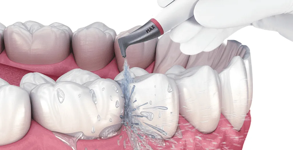 GBT Air Flow | vertexdentalthailand.com